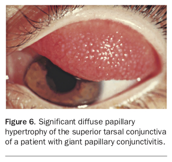 Follicular Vs Papillary Conjunctivitis